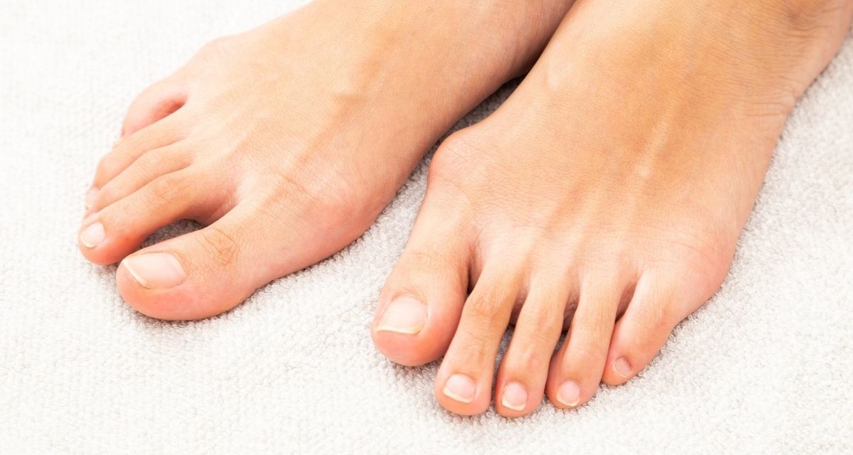 Bunion Treatment Options That Actually Relieve Pain and Improve Foot ...